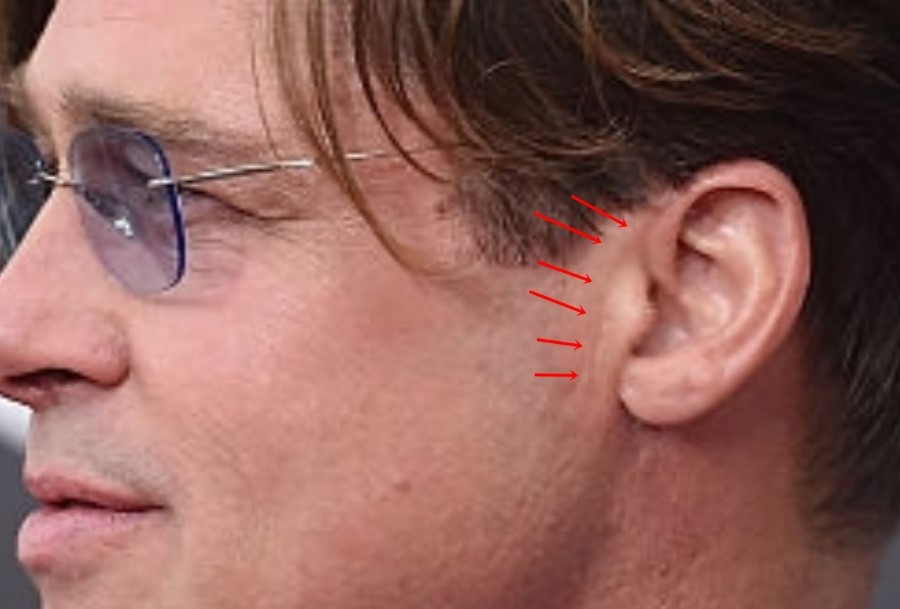 Brad Pitt Plastic Surgery Facelift Scar 27 Celebrity Plastic