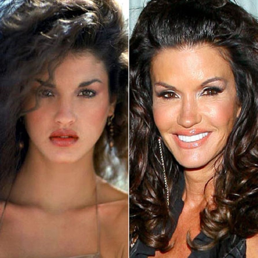 Janice Dickinson Before And After Plastic Surgery 02 Celebrity