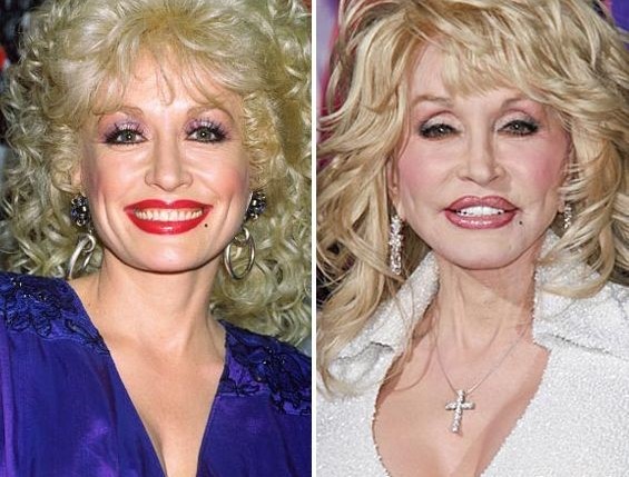 Dolly Parton before and after plastic surgery 04 | Celebrity plastic ...