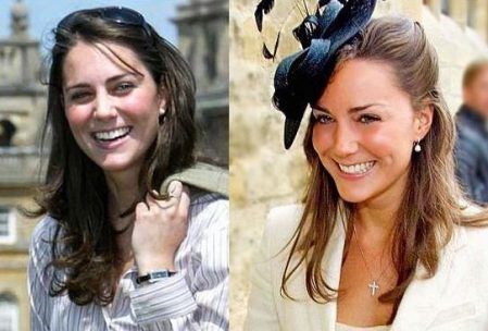 Kate Middleton The Duchess of Cambridge and Plastic Surgery?