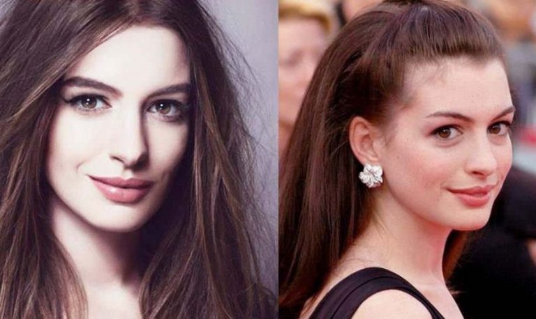 Anne Hathaway - Before and After Plastic Surgery