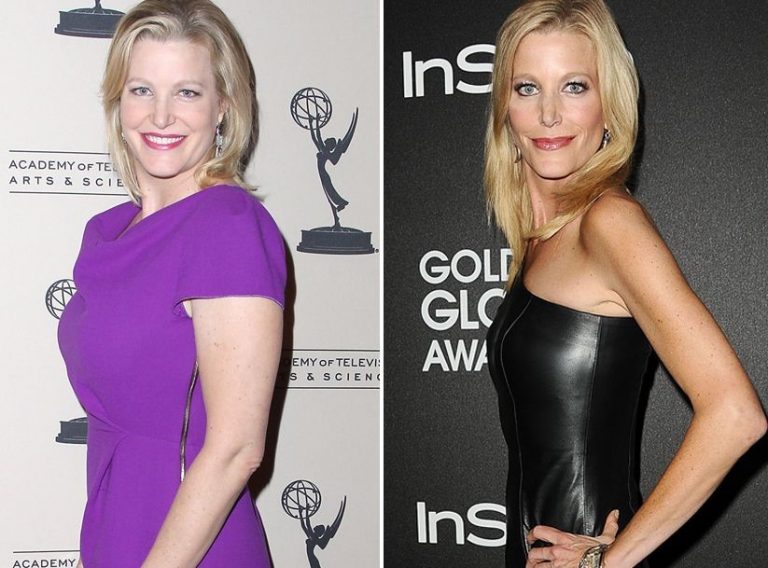 Anna Gunn Breaking Bad and plastic surgery