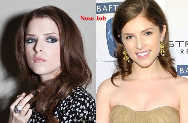 Anna Kendrick what plastic surgeries did she use?