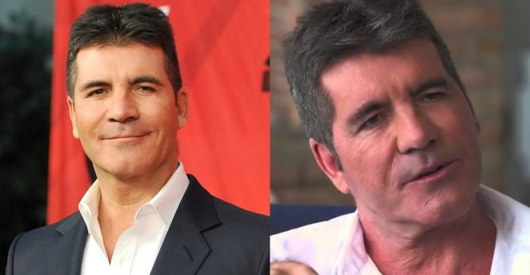 Simon Cowell and plastic surgery