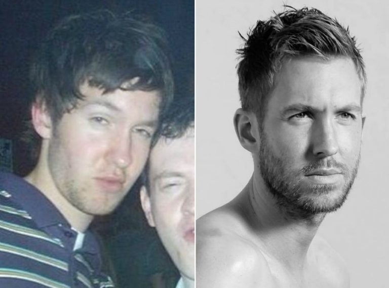 Calvin Harris and Plastic Surgery Transformation